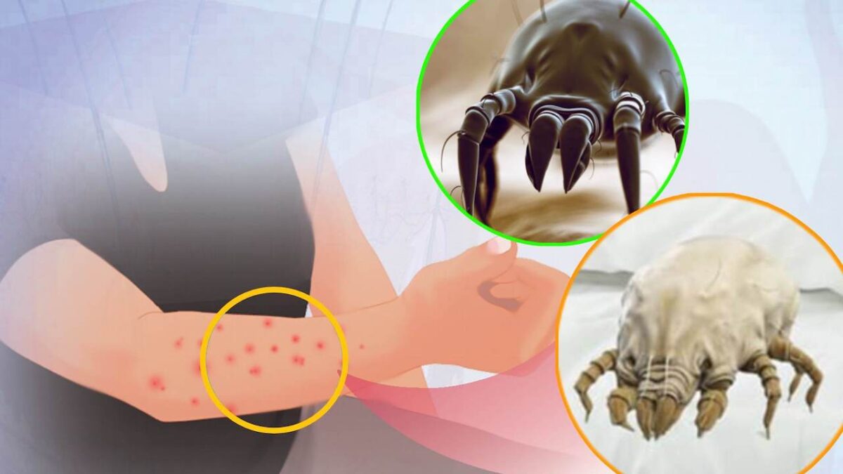 Punture di acari: come riconoscerle e curarle (oltre che prevenire) Punture di acari: come riconoscerle e curarle (oltre che prevenire)